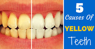 The causes and the cures of yellow teeth you should know - The Maravi Post
