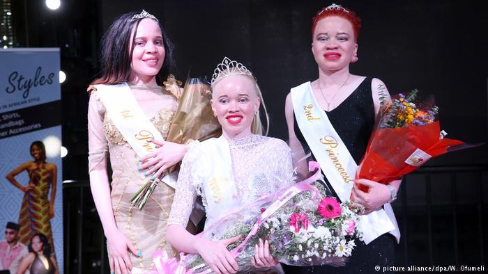 Zimbabwe Crowns Miss Albino in Bid to End Stigma - The Maravi Post